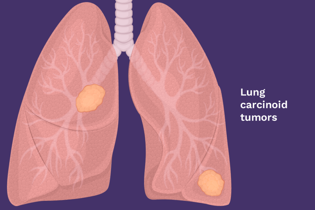 Understanding the Different Types of Lung Cancer - Ready Healthy & Able ...